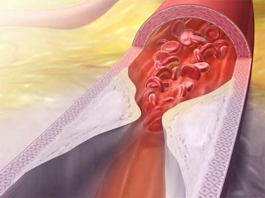 Atherosclerosis: The Anatomy and Physiology of a (Silent) Killer