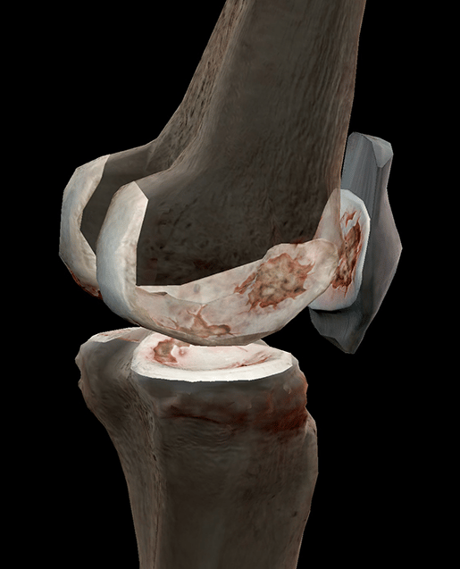 New Year, New Me, Old Knees: Degenerated Articular Cartilage ...