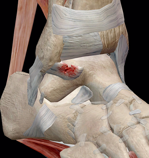 Just RICE It: The Anatomy and Pathology of Sprains