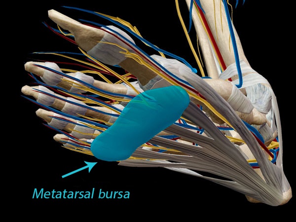 Metatarsal Bursitis
