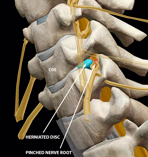 In a Pinch: The Anatomy and Pathology of Cervical Radiculopathy