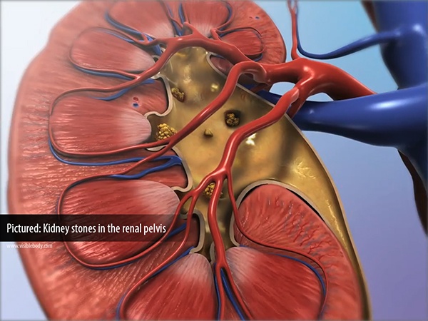 Painful Pebbles: The Anatomy and Pathology of Kidney Stones