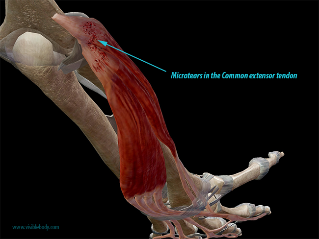 Stop Making a Racquet: A Look at Lateral Epicondylitis (Tennis Elbow)