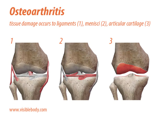 New Year, New Me, Old Knees: Degenerated Articular Cartilage ...