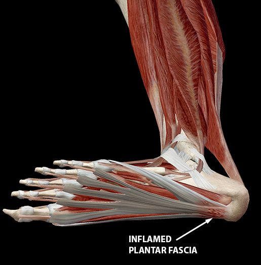 Run With This: Anatomy, Physiology, and Pathology of Plantar Fasciitis