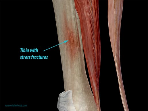 Hold on to Your Tibias: The Anatomy and Causes of Shin Splints