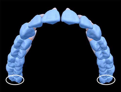 Wise Up! Three "Whys" of Wisdom Teeth