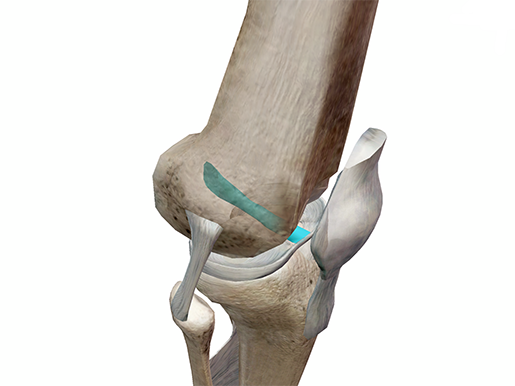 A Tale of Kittens and Ballers: The Anatomy and Pathology of ACL Tears