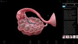What Is Polycystic Ovary Syndrome?