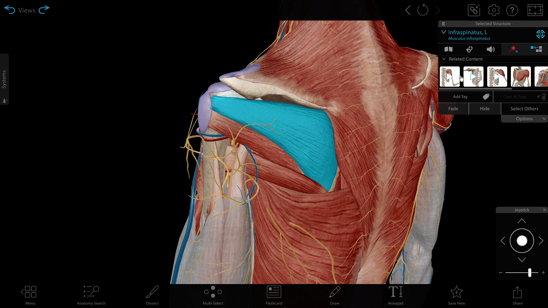 How to Teach Rotator Cuff Injuries with VB Suite