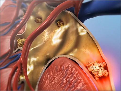 Painful Pebbles: The Anatomy and Pathology of Kidney Stones