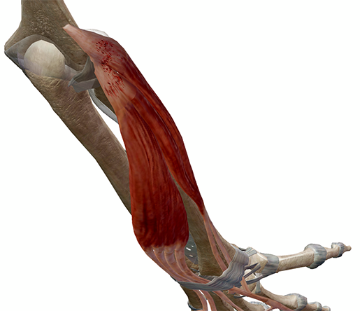 Stop Making a Racquet: A Look at Lateral Epicondylitis (Tennis Elbow)