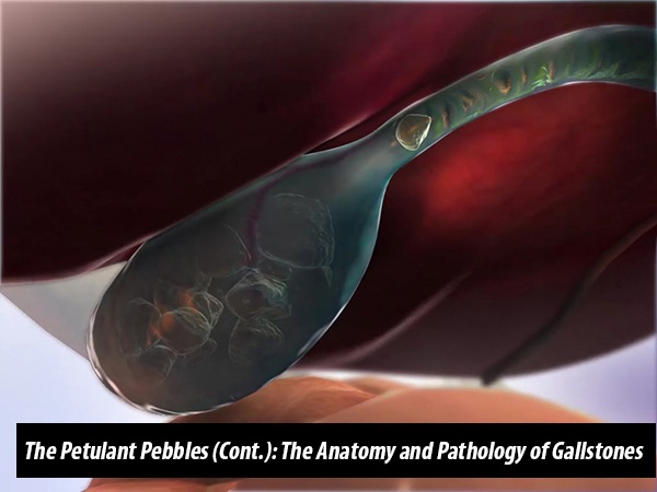 The Petulant Pebbles (Cont.): The Anatomy and Pathology of Gallstones
